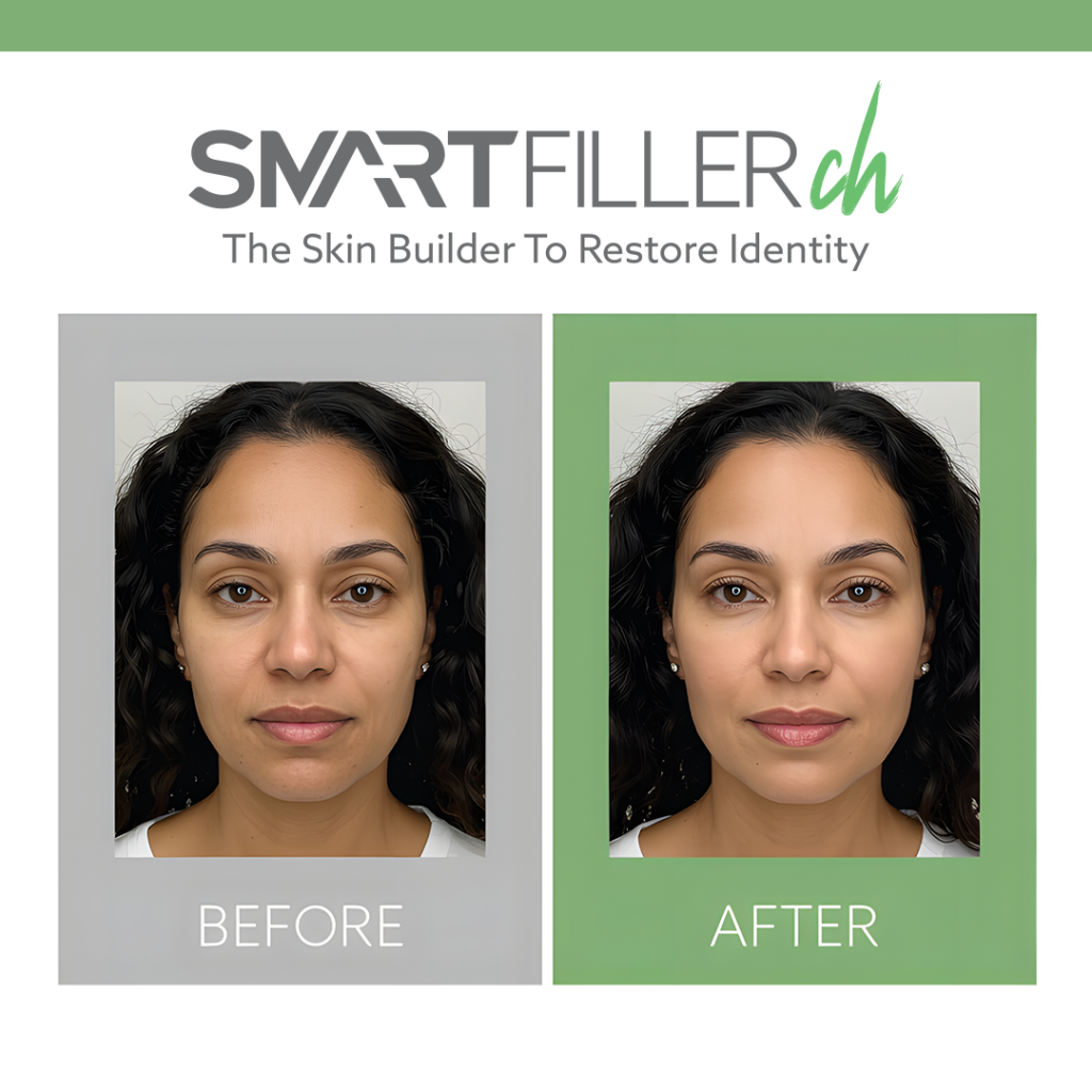 SMARTFILLER CH - GIMDERMA